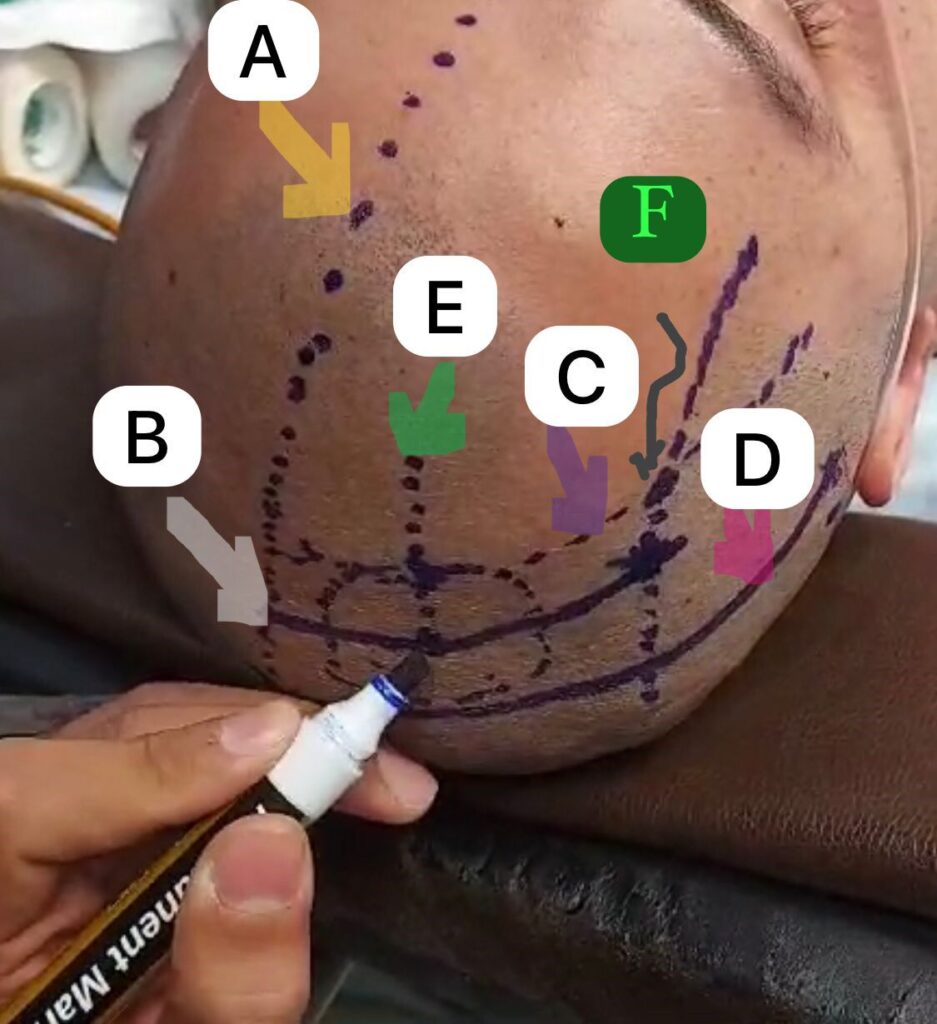 Al-Azhar Neurosurgery cases Qs& As - Al-Azhar Neurosurgery